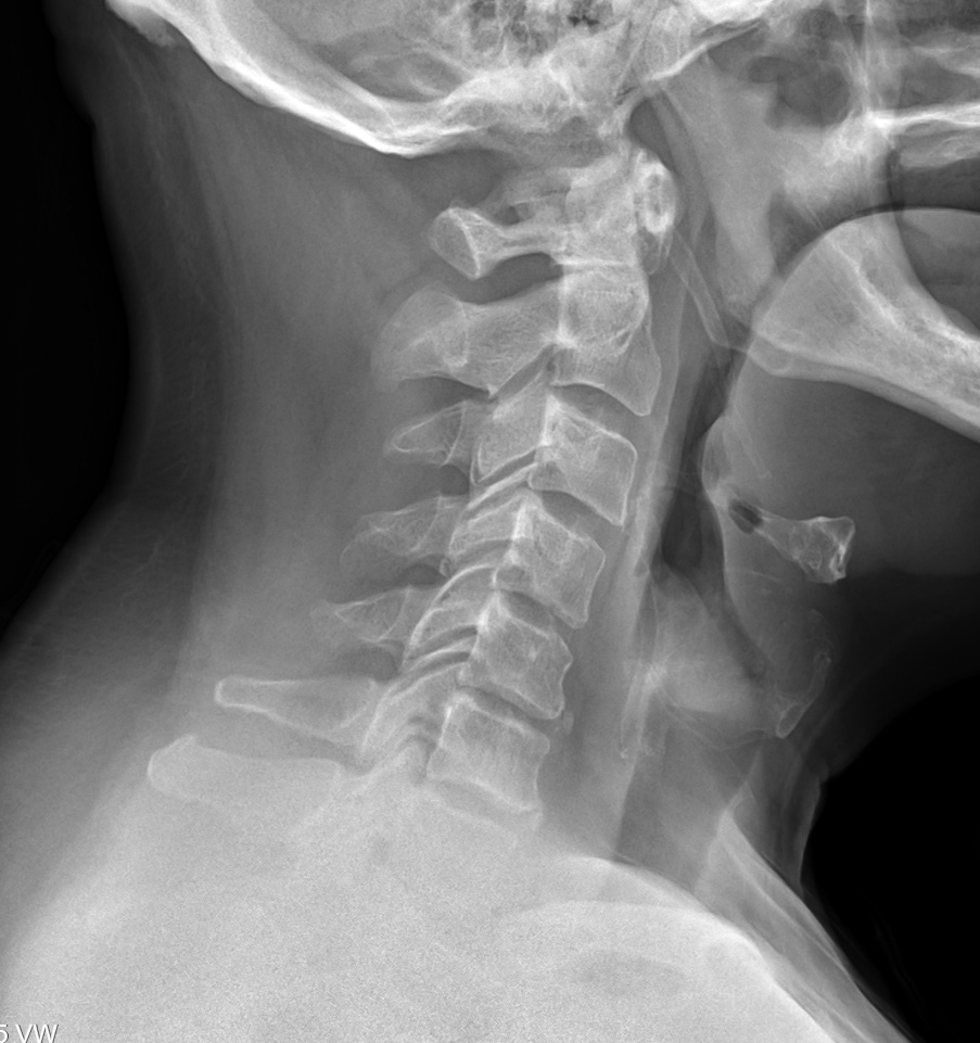 2 level Cervical ADR Case Study - J.A.