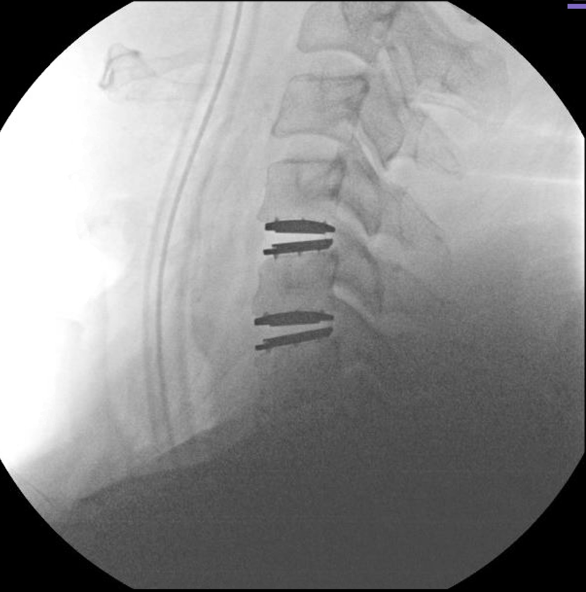 2 level Cervical ADR Case Study - J.A.