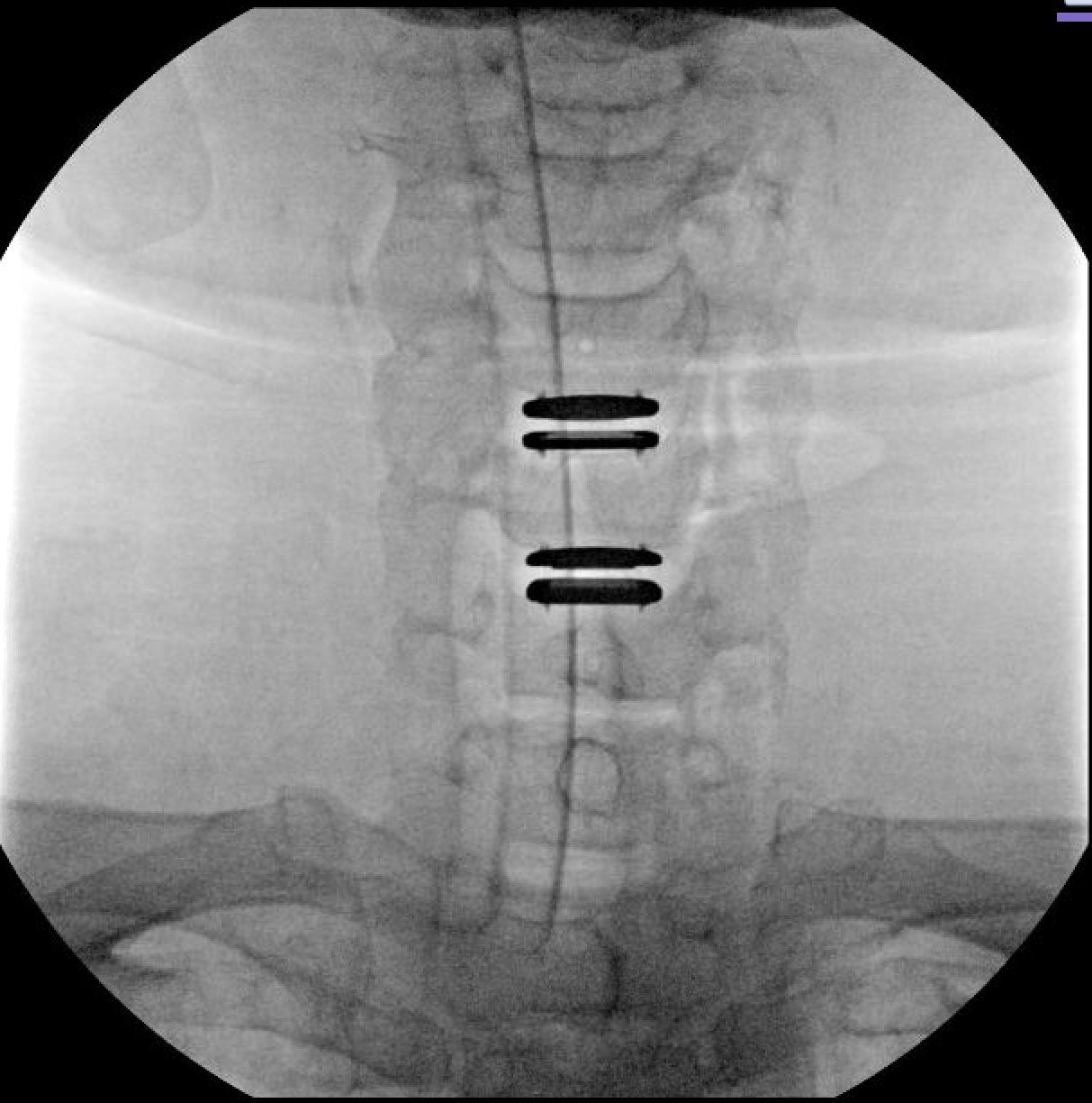 2 level Cervical ADR Case Study - J.A.