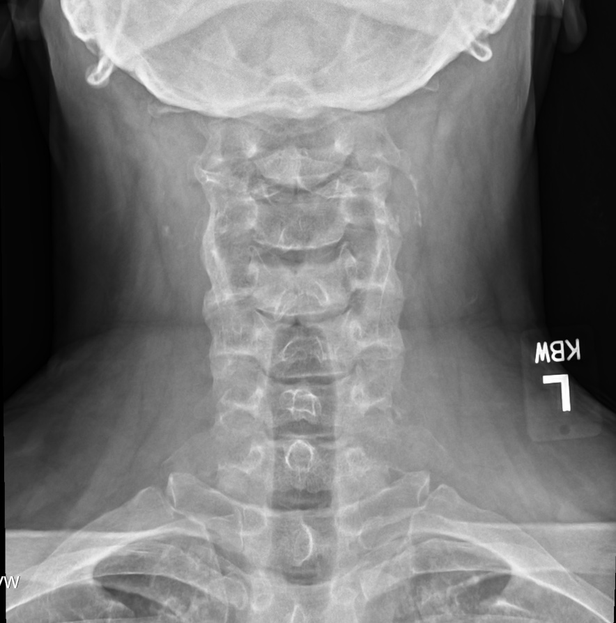 2 level Cervical ADR Case Study - J.A.