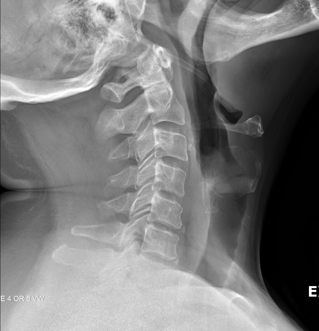 2 level Cervical ADR Case Study - J.A.