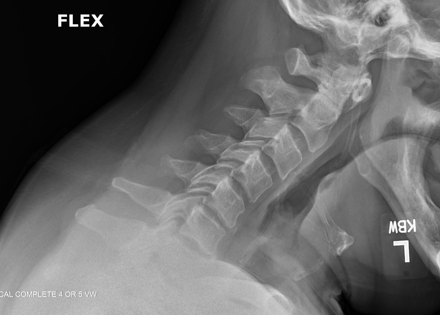 2 level Cervical ADR Case Study - J.A.