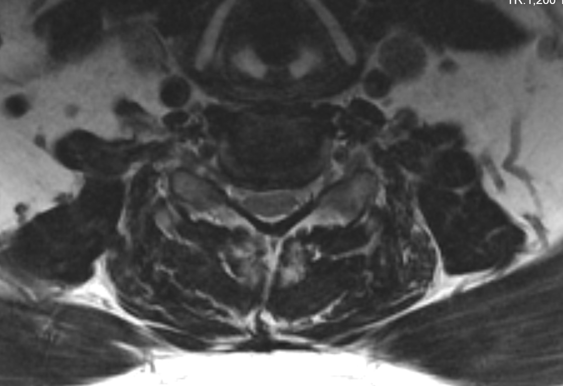 2 level Cervical ADR Case Study - J.A.