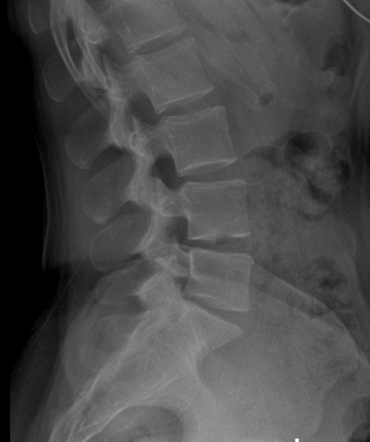 2 level Lumbar ADR Case Study - K.W.