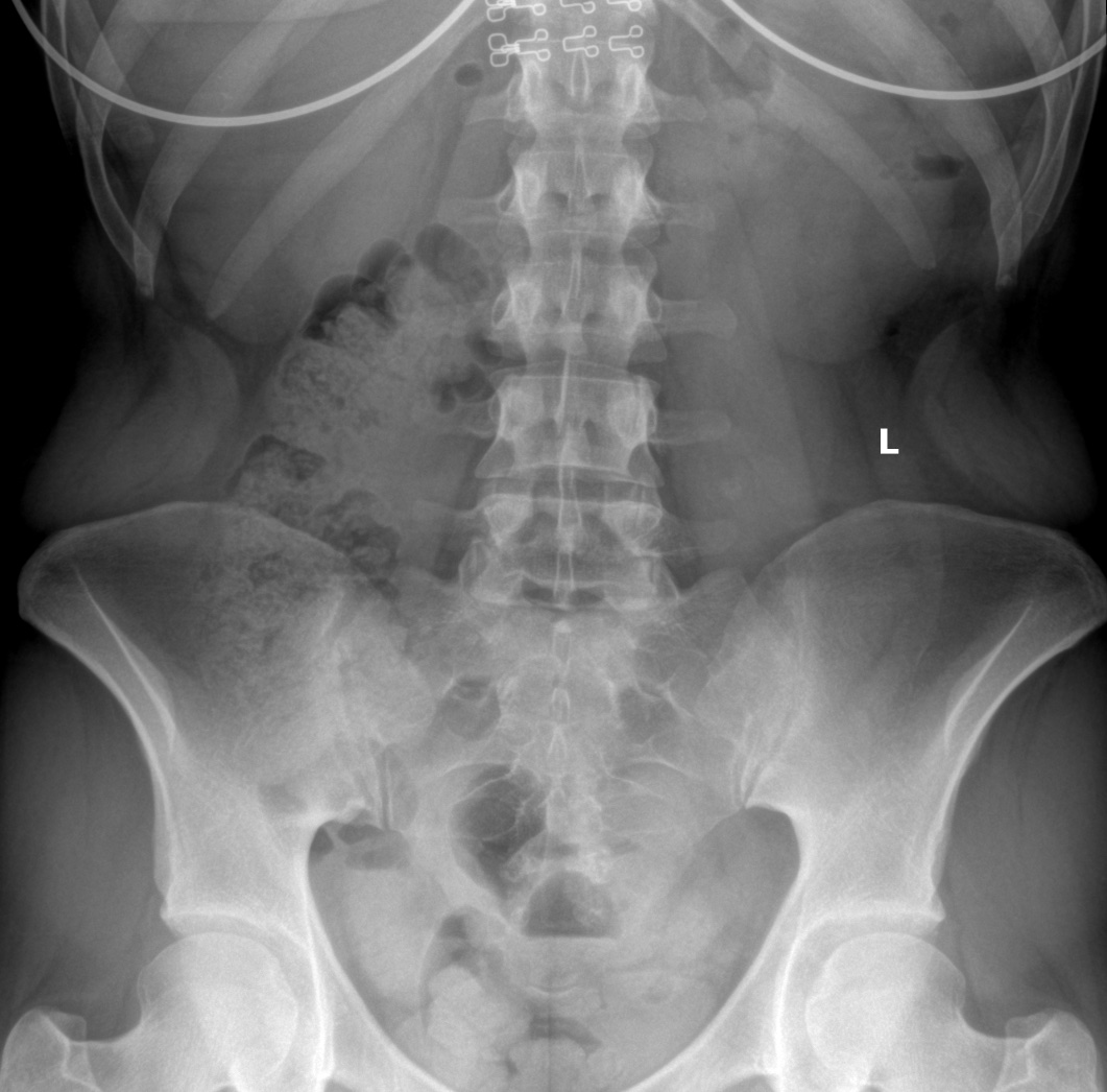 2 level Lumbar ADR Case Study - K.W.