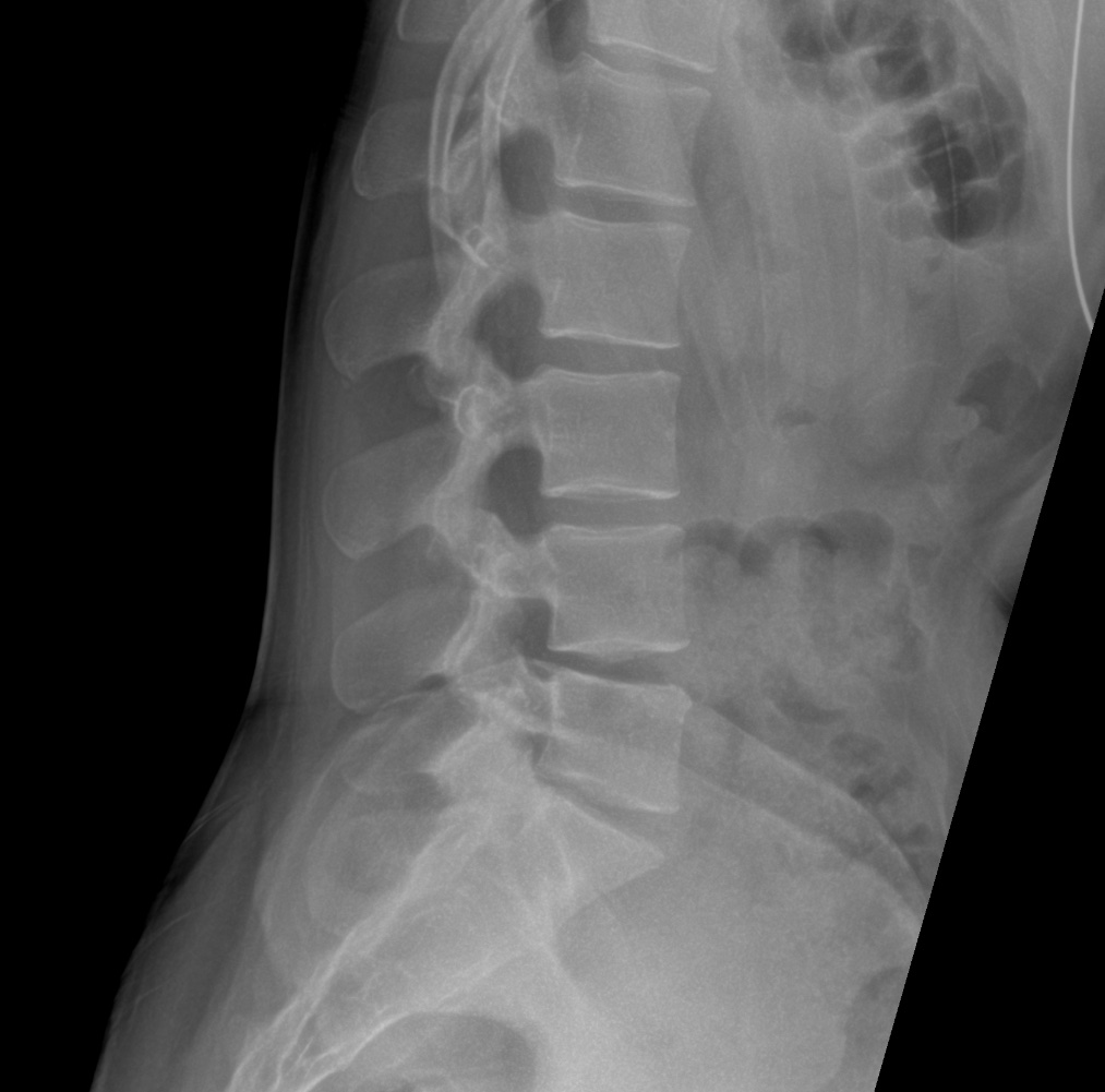 2 level Lumbar ADR Case Study - K.W.