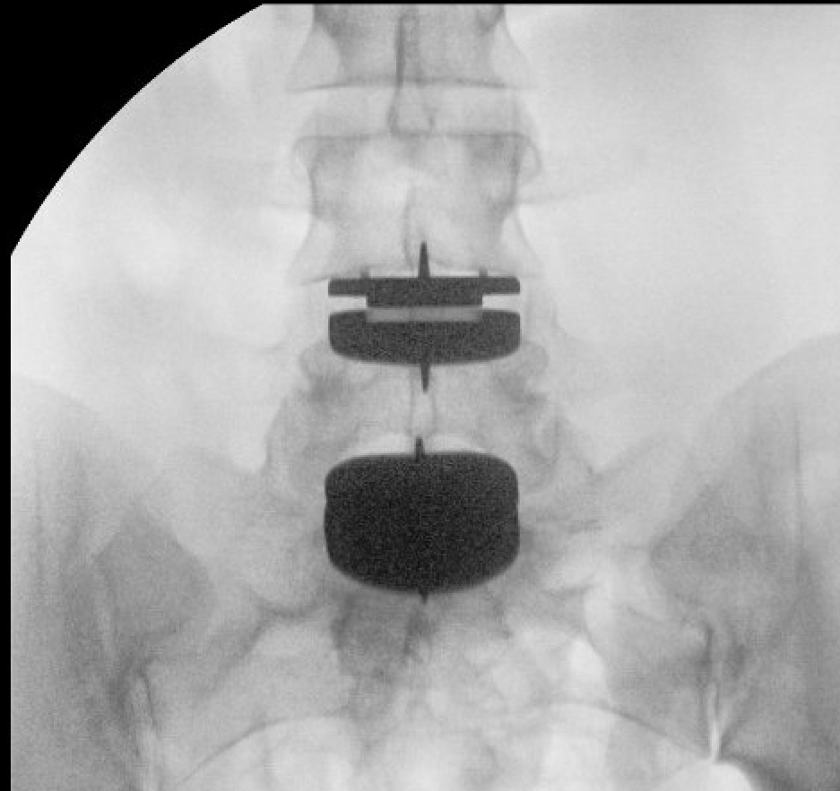 2 level Lumbar ADR Case Study - K.W.
