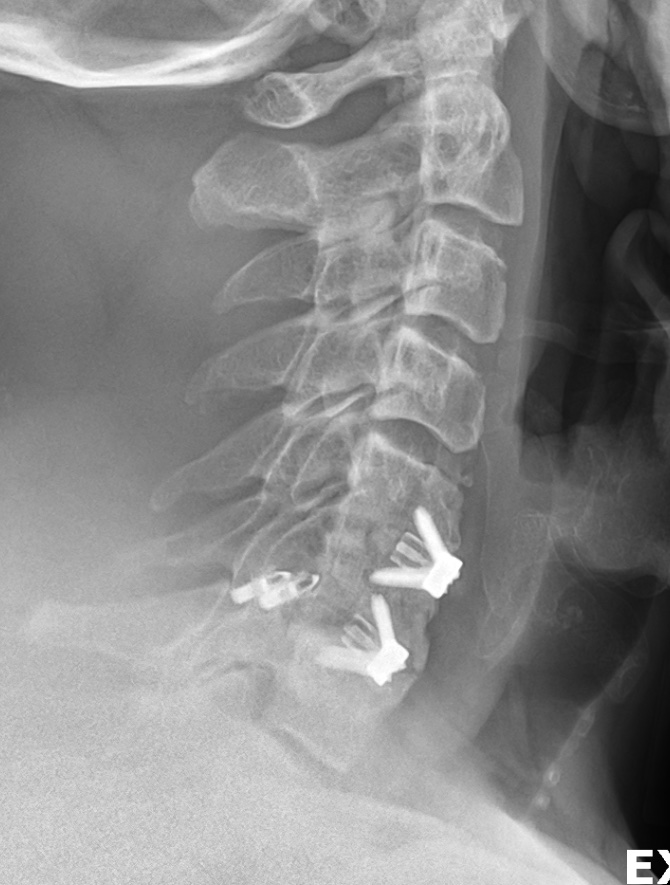 Minimally Invasive Posterior Cervical Revision Fusion Case Study - J.S ...