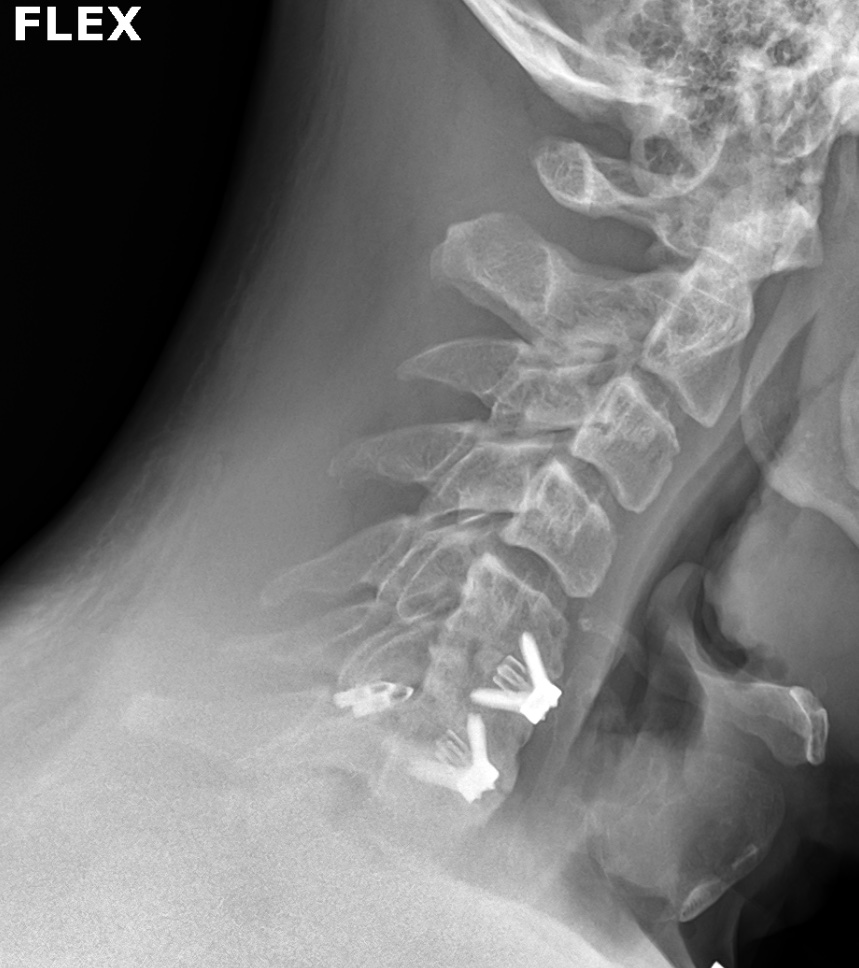 Minimally Invasive Posterior Cervical Revision Fusion Case Study - J.S ...