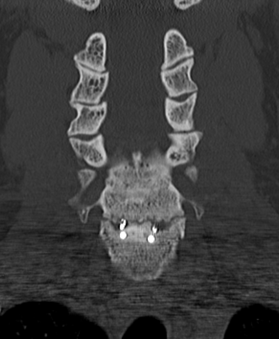 Minimally Invasive Posterior Cervical Revision Fusion Case Study - J.S ...