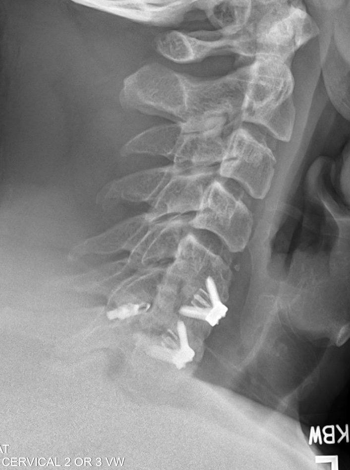 Minimally Invasive Posterior Cervical Revision Fusion Case Study - J.S ...