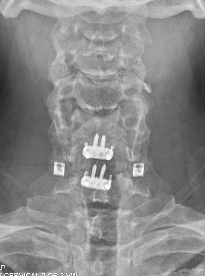 Minimally Invasive Posterior Cervical Revision Fusion Case Study - J.S ...