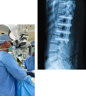 Spinal Implants & Design - K. Brandon Strenge, M.D.