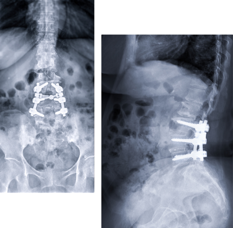 Spinal Implants & Design - K. Brandon Strenge, M.D.