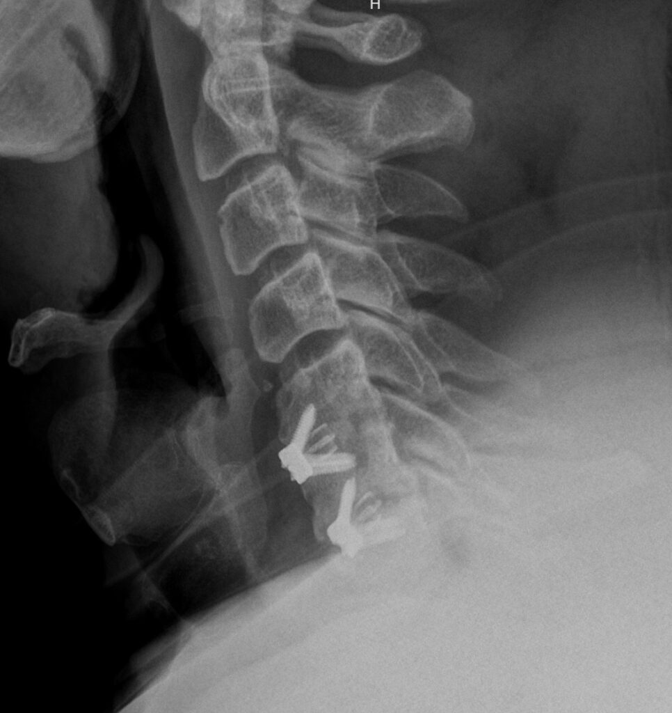 Minimally Invasive Posterior Cervical Revision Fusion Case Study - J.S ...